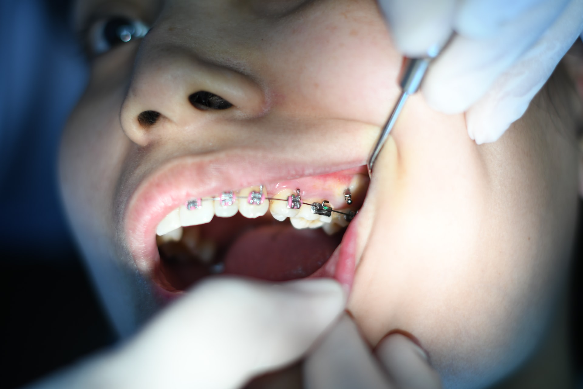 Combatting Bite Problems and Jaw Pain - On Demand Orthodontist